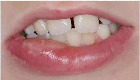 Pediatric Dental Emergency Ellisville | Emergency Dental Care for Kids